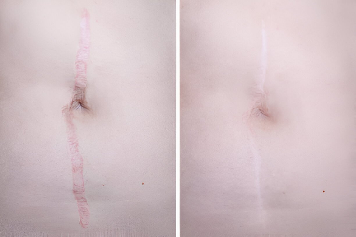 Skin Resurfacing And Scar Management | Skin Genesis Clinic