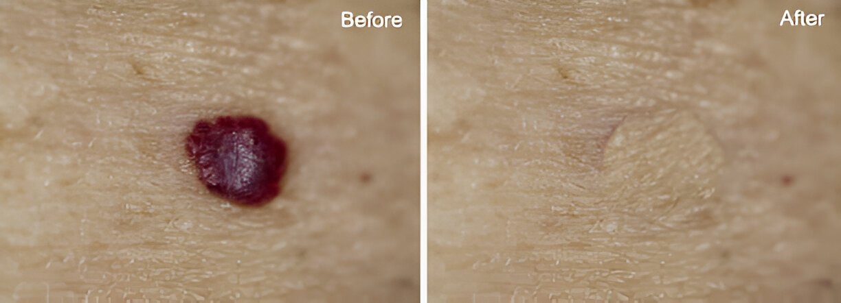 Benign Skin Lesions Excisions | Skin Genesis Clinic